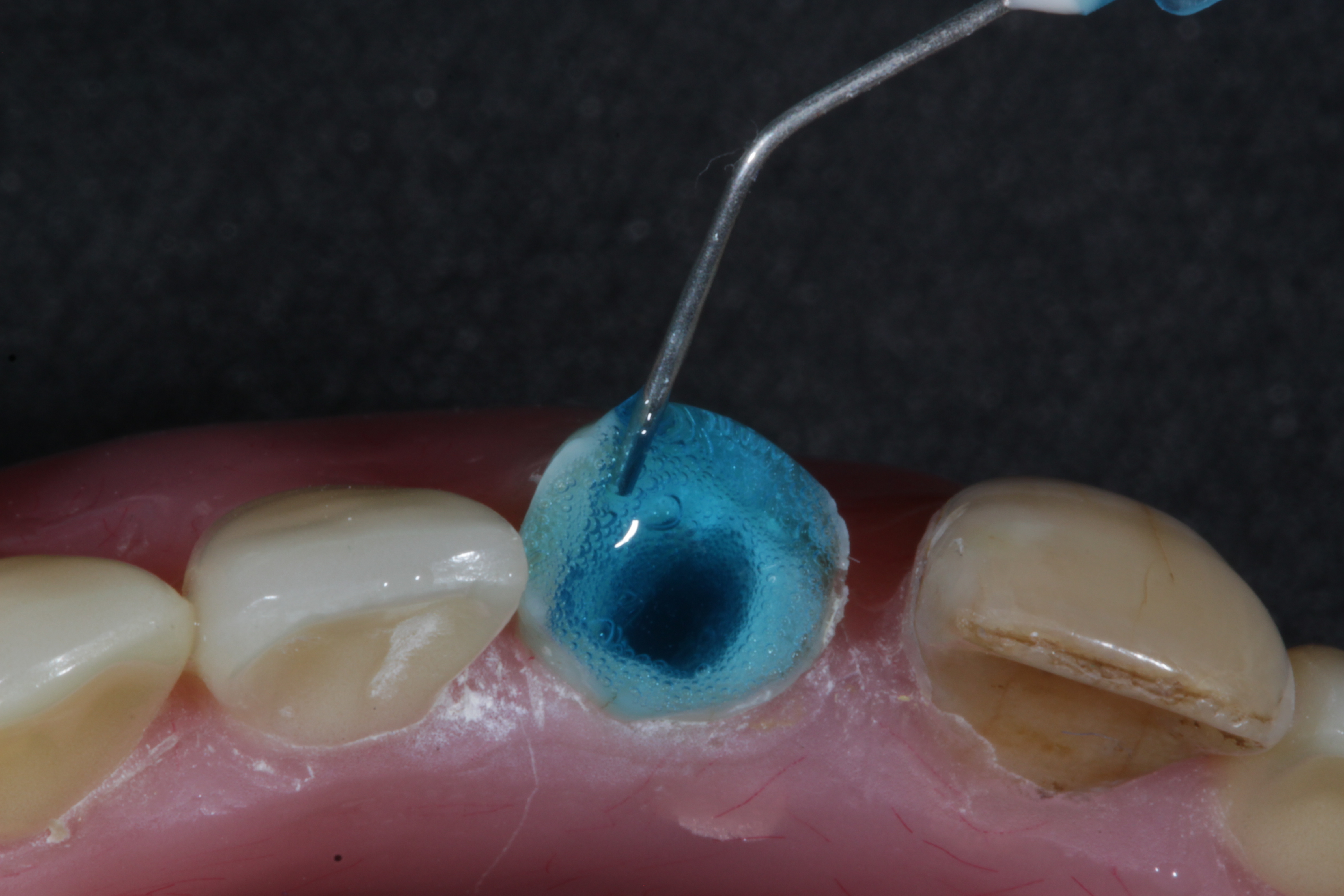 MiCD Fiber Filling: 4R protocol and applications